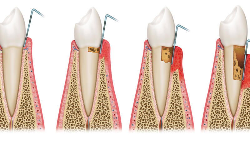 Parodontitis-Behandlung - dr. med. dent. eichenhofer